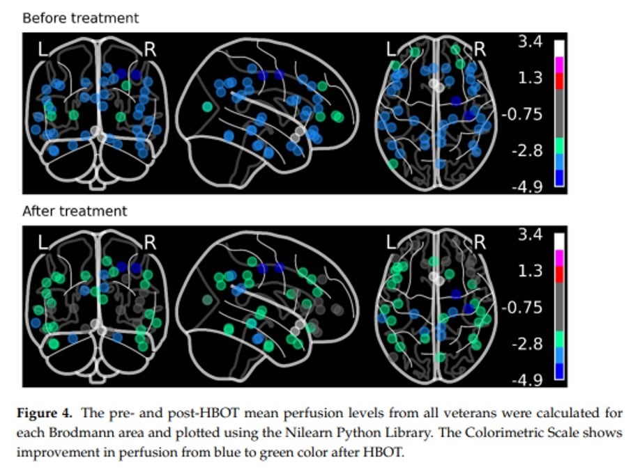 A Case Series of 39 United States Veterans with Mild Traumatic Brain ...